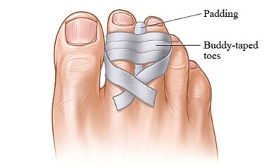 SO MANY WOMEN ARE TAPING THEIR MIDDLE TOES TOGETHER, AND YOU’LL WANT TO ...