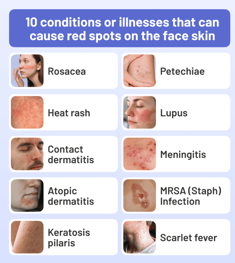 DO YOU HAVE THESE RED SPOTS ON VARIOUS PARTS OF YOUR BODY!!! - DocPe