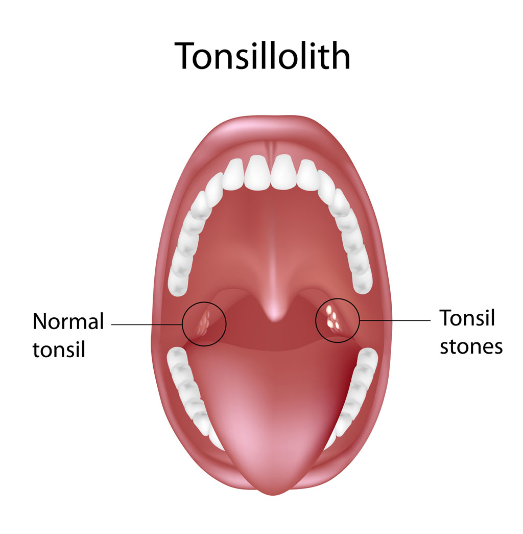 4 Effective Ways To Remove Tonsil Stones Without Surgery - DocPe