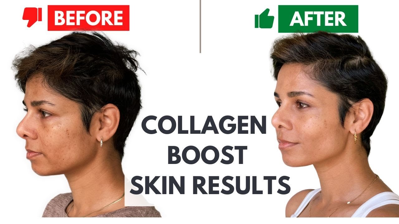 5 Ways to Boost Your Collagen Levels - DocPe